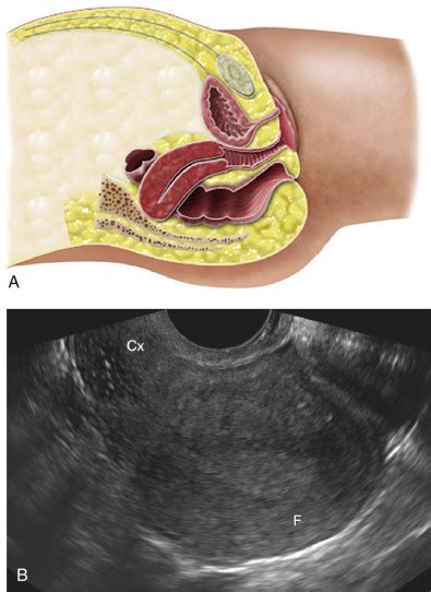 Retroverted Uterus Transabdominal Ultrasound