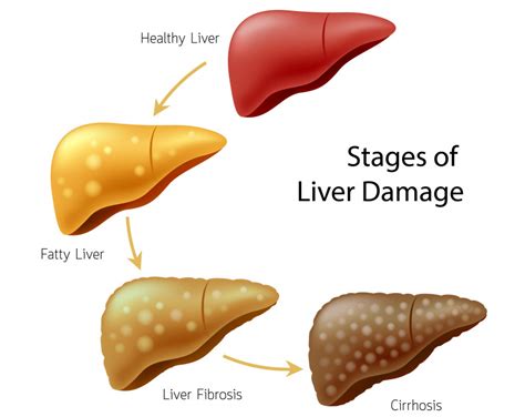 I Was Diagnosed With Fatty Liver Disease What Is It And Is This