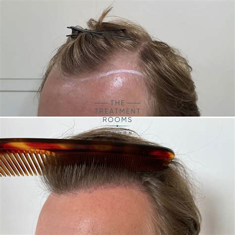 Hair Transplant Timeline What To Expect Treatment Rooms