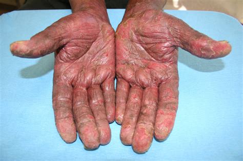 Necrolytic Acral Erythema