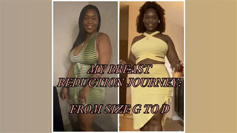 My Breast Reduction Journey Youtube