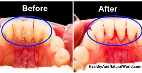 how to remove dental plaque naturally evidence based
