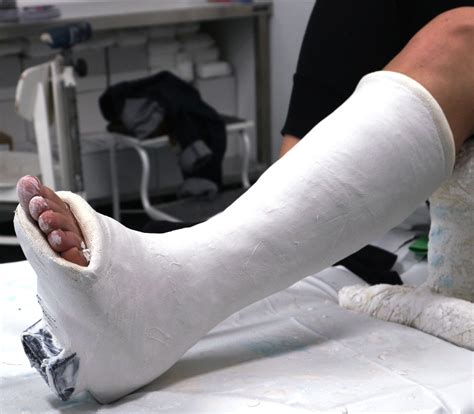 Who Can Put Such Plaster Cast On My Leg Yesomex On Tumblr