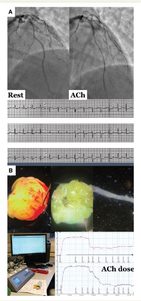 Figure 1 From Systemic Microvascular Dysfunction In Microvascular And