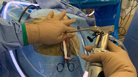Endoscopic Third Ventriculostomy The Neurosurgical Atlas
