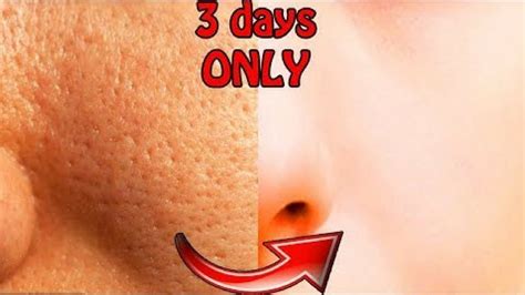 How To Get Rid Of Large Open Pores Permanently And Acne Scars Naturally