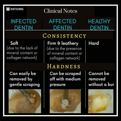 【vital Pulp Therapy】caries Management牙牙學齲 羚羊小姐（尾巴擺擺）