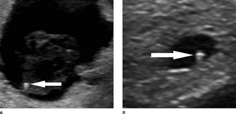 Nonshadowing Echogenic Foci In Thyroid Nodules Beland 2011