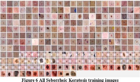 [pdf] Isic 2017 Skin Lesion Analysis Towards Melanoma Detection