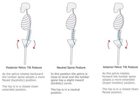 6 Minute Anterior Pelvic Tilt Exercise Routine Ach