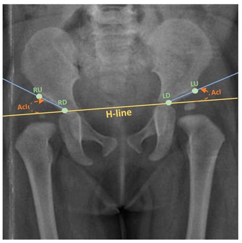 J Imaging Free Full Text Assessing Acetabular Index Angle In