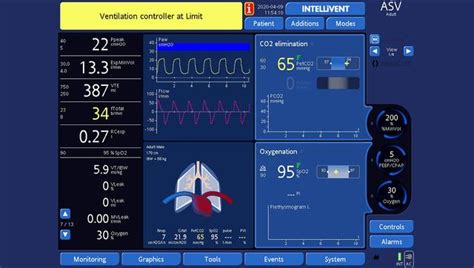 Intellivent Asv Olat