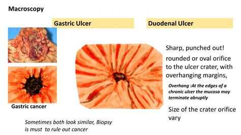 Gastric Vs Duodenal Ulcers Pathology Made Simple