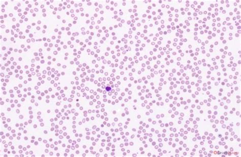 Haemoglobin Q H Disease Learnhaem Haematology Made Simple