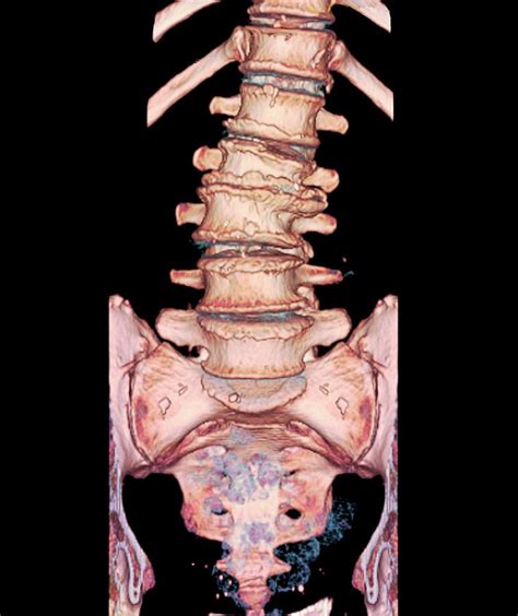 Spinal Compression Fracture Photograph By Zephyr Science Photo Library