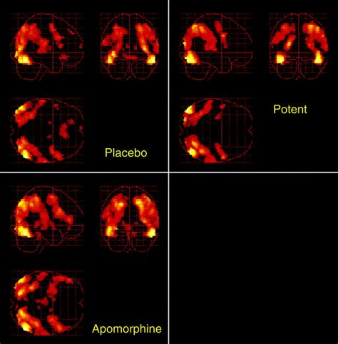 Brain Activation Patterns During Video Sexual Stimulation Following The