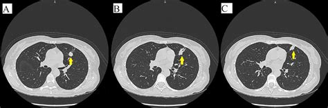 Cureus A Rare Case Of An Occult Primary Tumor With A Profile Of Colon