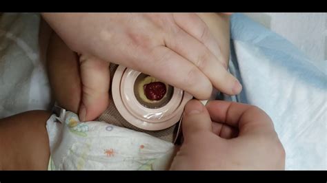 Putting A New Ostomy Colostomy Kit On An Infant Youtube