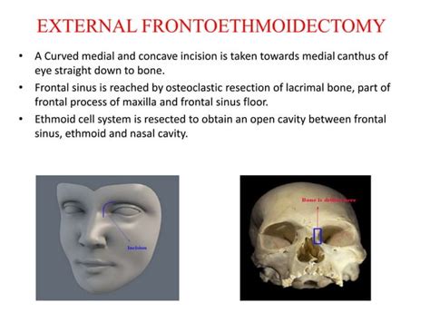 Surgical Approaches To Frontal Sinus Ppt Ppt