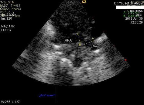 وليد مع زرقة مركزيّة حوّل إلي طفل بعمر 5 أيّام و وزن 2 6 كغ بشكوى زرقة