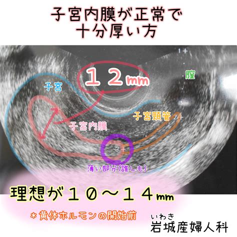 【子宮内膜1㎜〜2㎜】閉経した方のエコー画像との見比べ やえ様 岩城産婦人科妊活ブログ