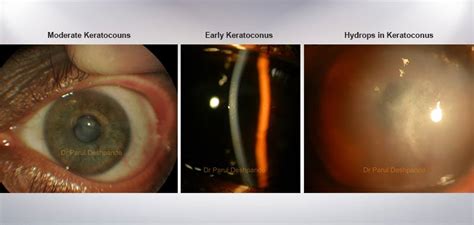 Keratoconus Sarvodaya Eyecare Experts