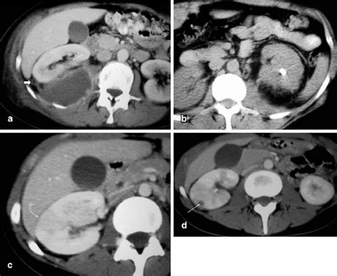 A D Acute Pyelonephritis A Contrast Enhanced Ct Scan Showing Low