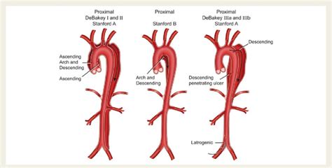 Stanford Classification Of Aortic Dissection Radiolog