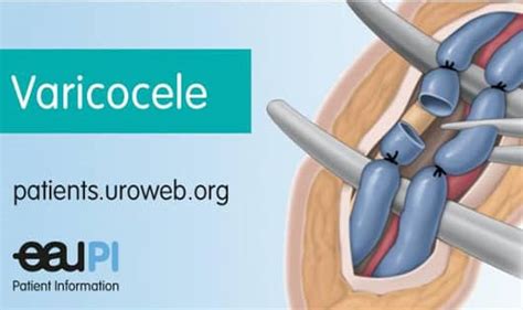 Varicocele Male Infertility Embolization Vascular Interventions