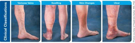 chronic venous insufficiency cvi department of surgery suny