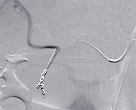 Image Of Coil Embolization Passage To The Superior Mesenteric Artery
