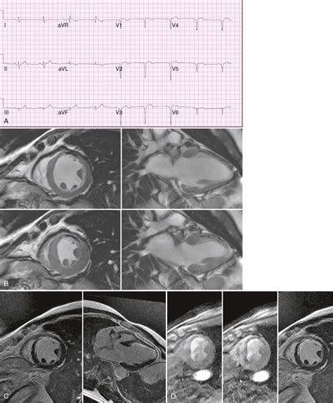 Dilated Cardiomyopathy And Myocardial Infarction Radiology Key