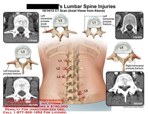Transverse Process Fracture Treatment