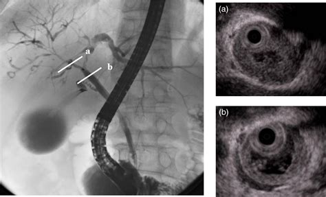 Clinical Practice Guidelines For Igg4‐related Sclerosing Cholangitis