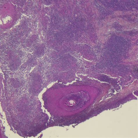 Biopsy Of The Skin Lesion × 25 Magnification Hematoxylin Eosin Saffron