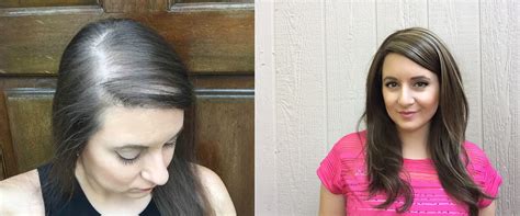 Hereditary Hair Loss Female Atelier Yuwa Ciao Jp