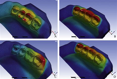 Three Dimensional Finite Element Analysis Of Implant Assisted Removable