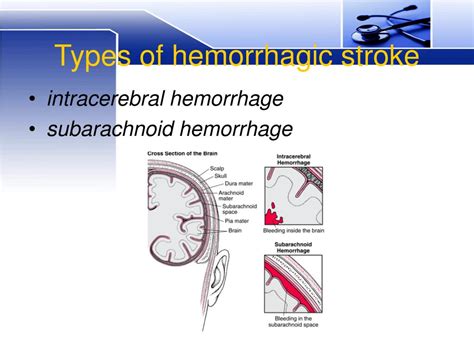 Ppt Hemorrhagic Stroke Powerpoint Presentation Free Download Id