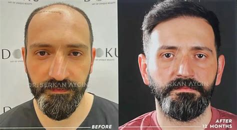 Hair Transplant Timeline What To Expect From Day 1 And Beyond Dr