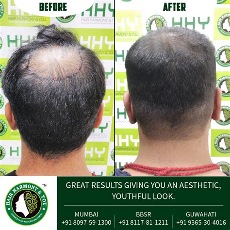 Hair Transplant Result
