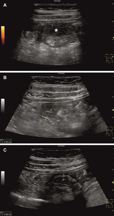 Frontiers Case Report A Rare Cause Of Intestinal Perforation In A