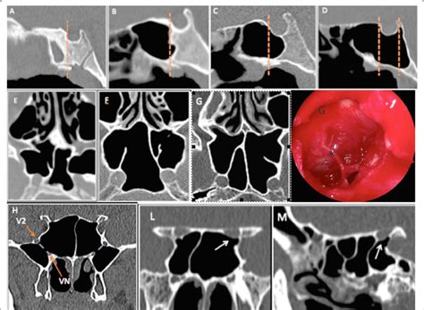Güldners Classification 7 Of Sphenoid Sinus Pneumatization On Sagittal