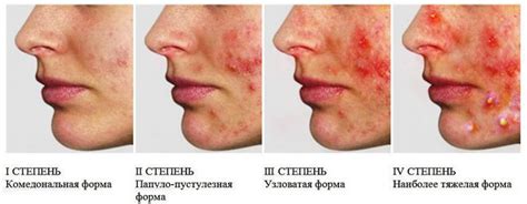 Виды прыщей на лице виды лечение