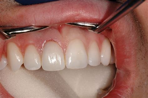 Single Tooth Replacement With Implants Dallas Tx Charles F Orth Dds Pa