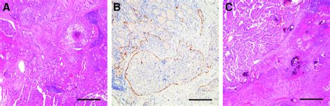 Histopathological Features Of Diffuse Sclerosing Variant Of Papillary