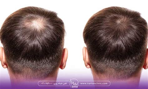 آشنایی با انواع روش های کاشت مو و نکات ضروری سالم زیبا