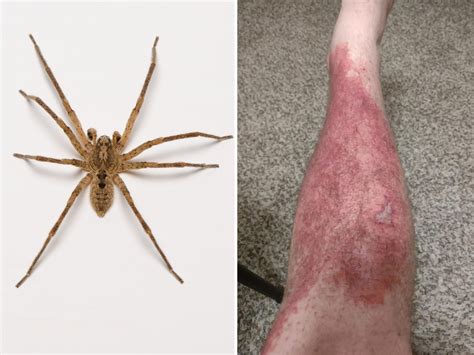 Brown Recluse Spider Bite First Stage