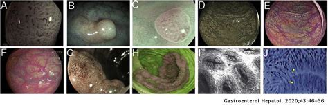 Advanced Endoscopy Technologies To Improve The Detection And