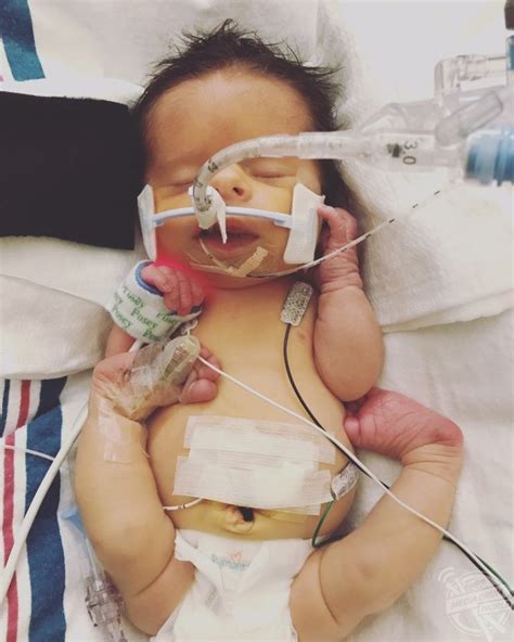 Girl With Rarest Form Of Dwarfism Defies Doctors Who Believed She