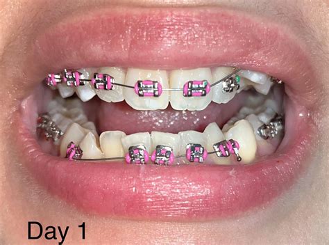 Happy First Anniversary To My Braces R Braces